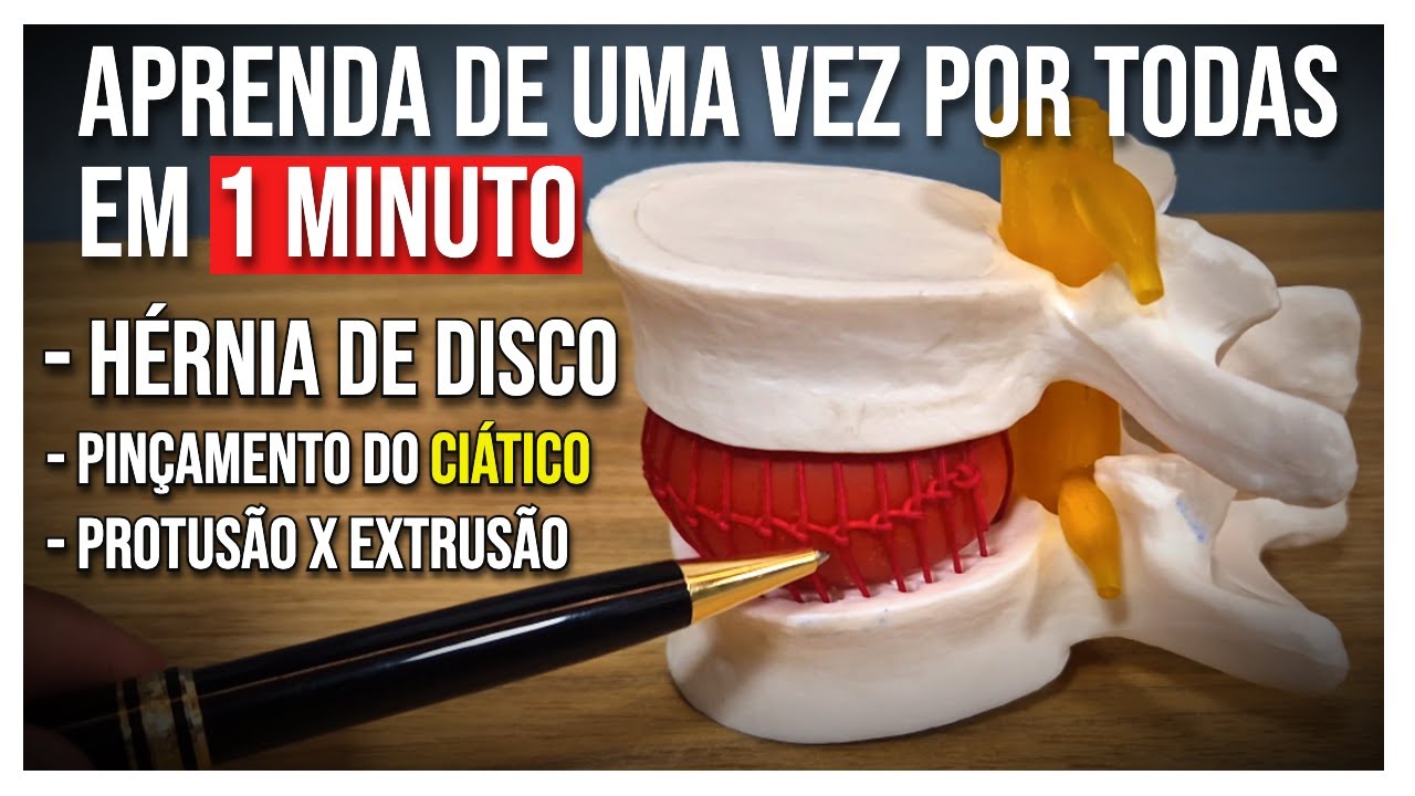 Hérnia de Disco Lombar Explicada em Modelo Colorido por Cirurgião de ...