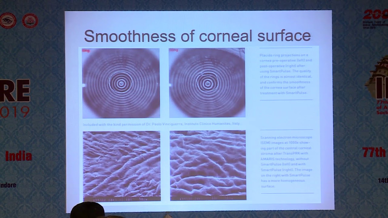 AIOC2019 GP77 Topic SPT Smart Pulse Technology in LASIK Dr Santosh ...