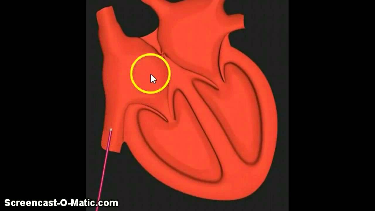 PFO Closure - YouTube