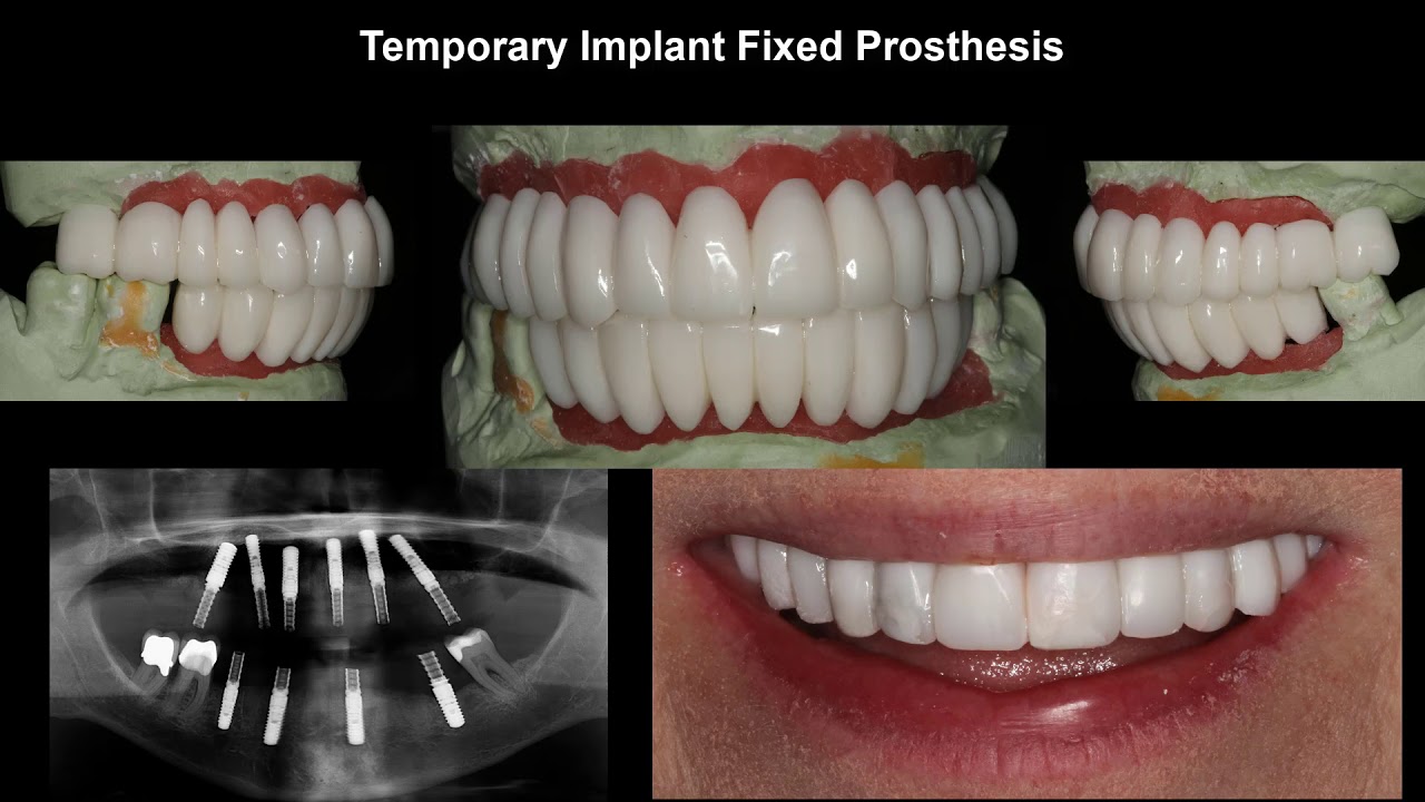 Implant Full Arch Fixed Prosthesis - YouTube