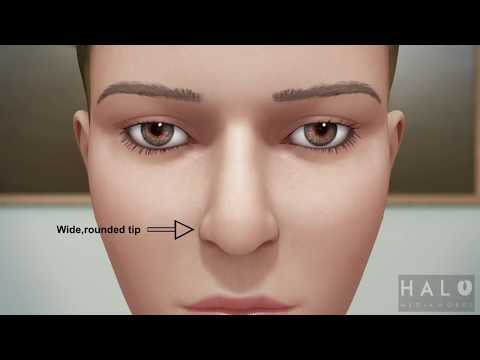 Rinoplasti Ameliyatı Animasyon - Doç. Dr. Alper YENİGÜN