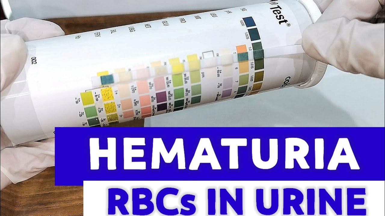 Hematuria: Red Blood Cells in Urine| Medical Laboratory Science - YouTube