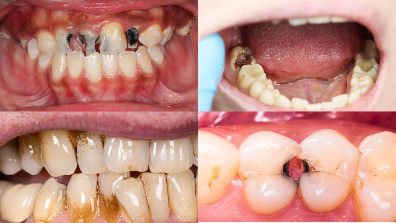 The Dental Disease You Don t Know About How To Identify Tooth Decay The Dental Disease You Don t Know About How To Identify Tooth Decay