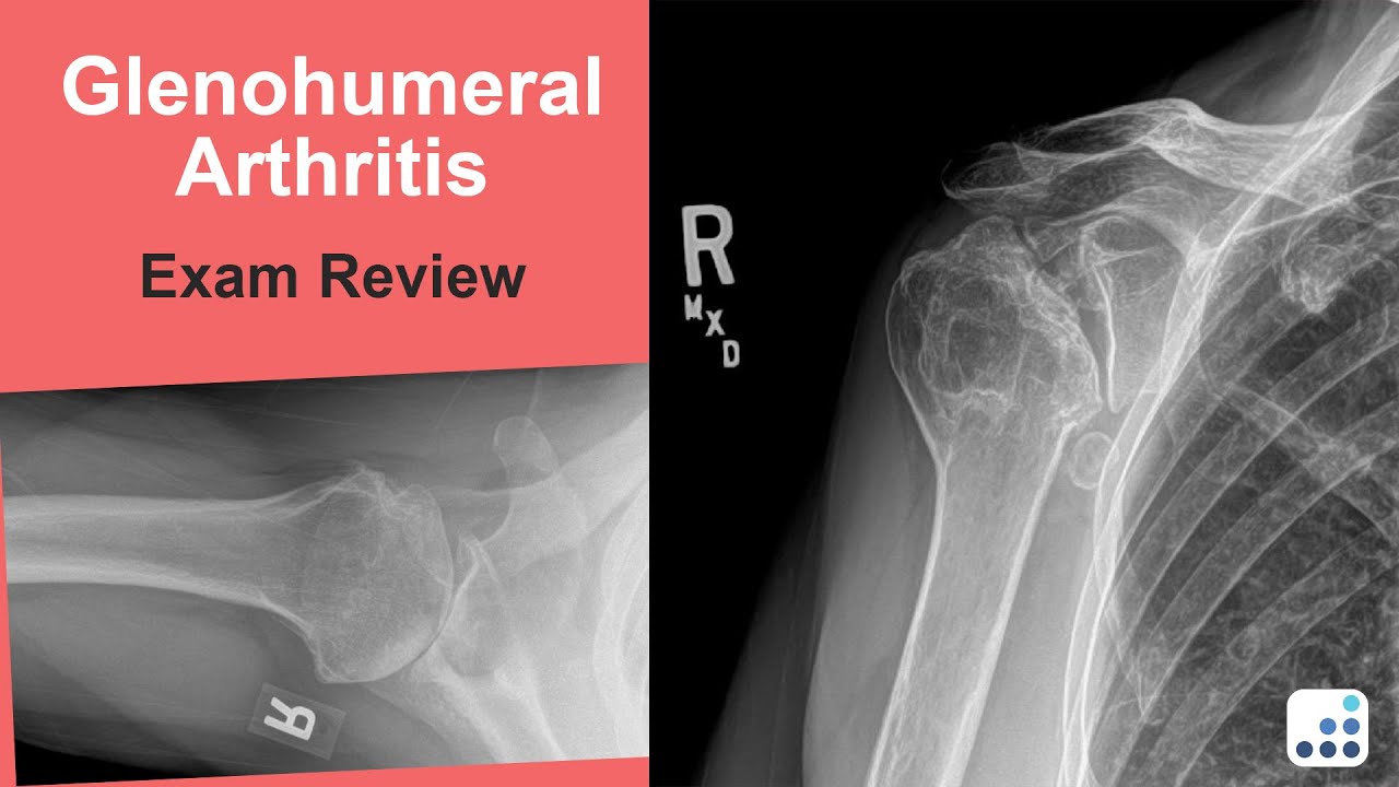 Glenohumeral Arthritis Exam Review - Anthony Romeo, MD - YouTube