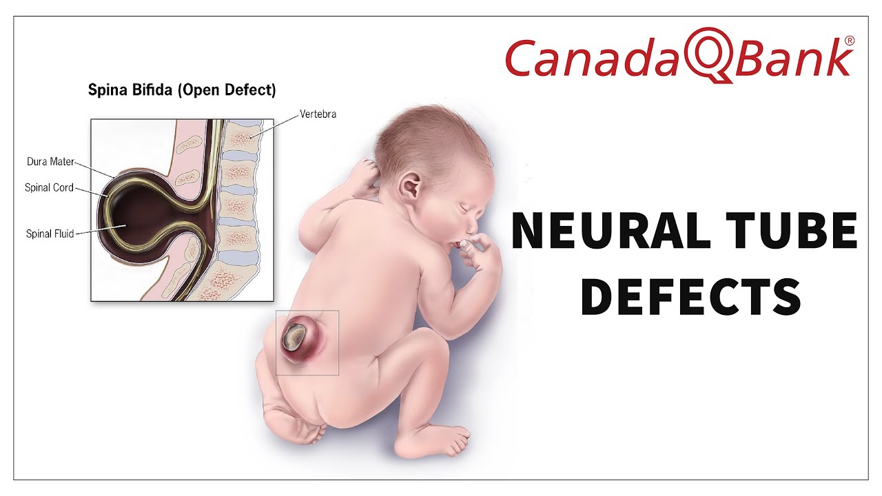 Neural Tube Defects (NTDs): Types, Causes & Prevention | High-Yield Embryology | CanadaQBank ...
