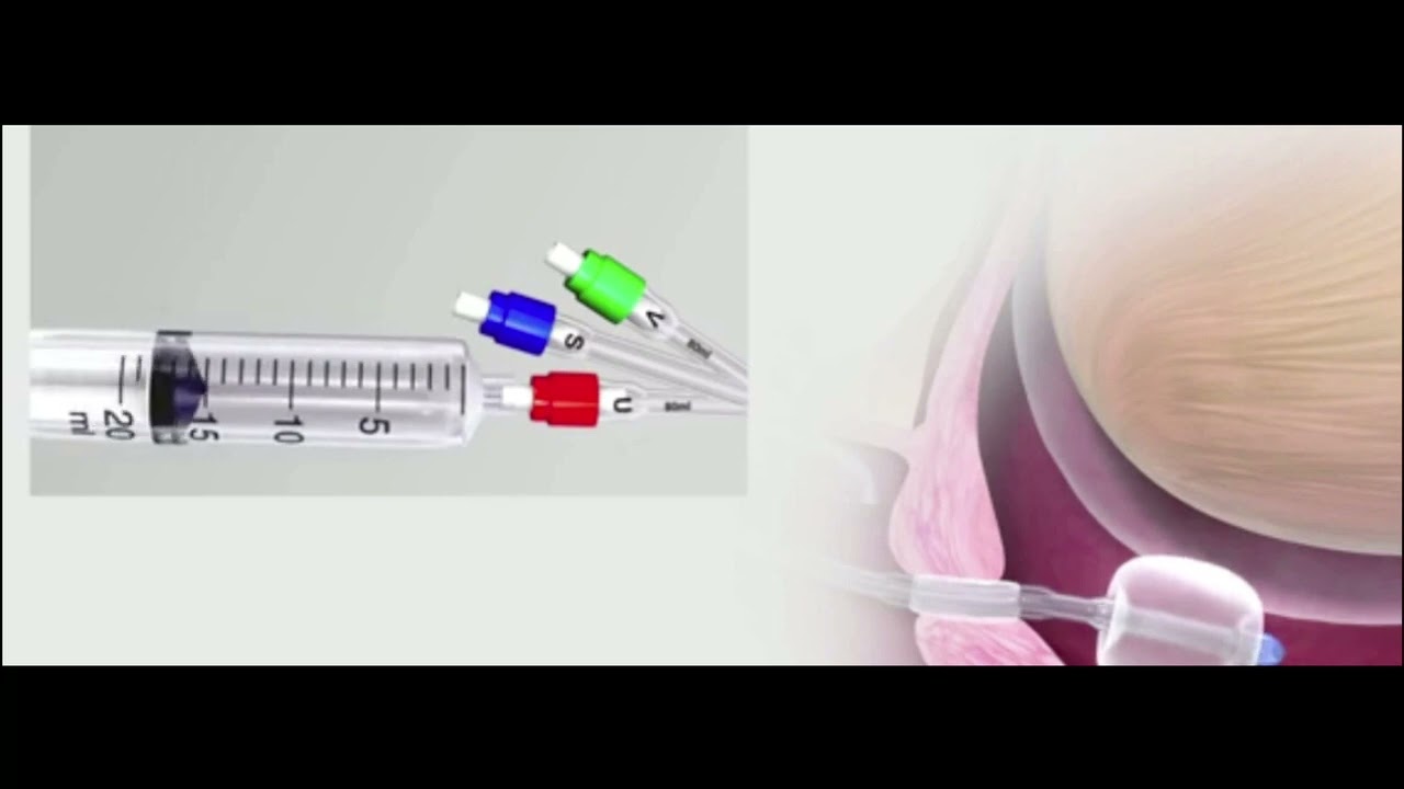 Inducción del parto con catéter de doble balón (cuff). - YouTube