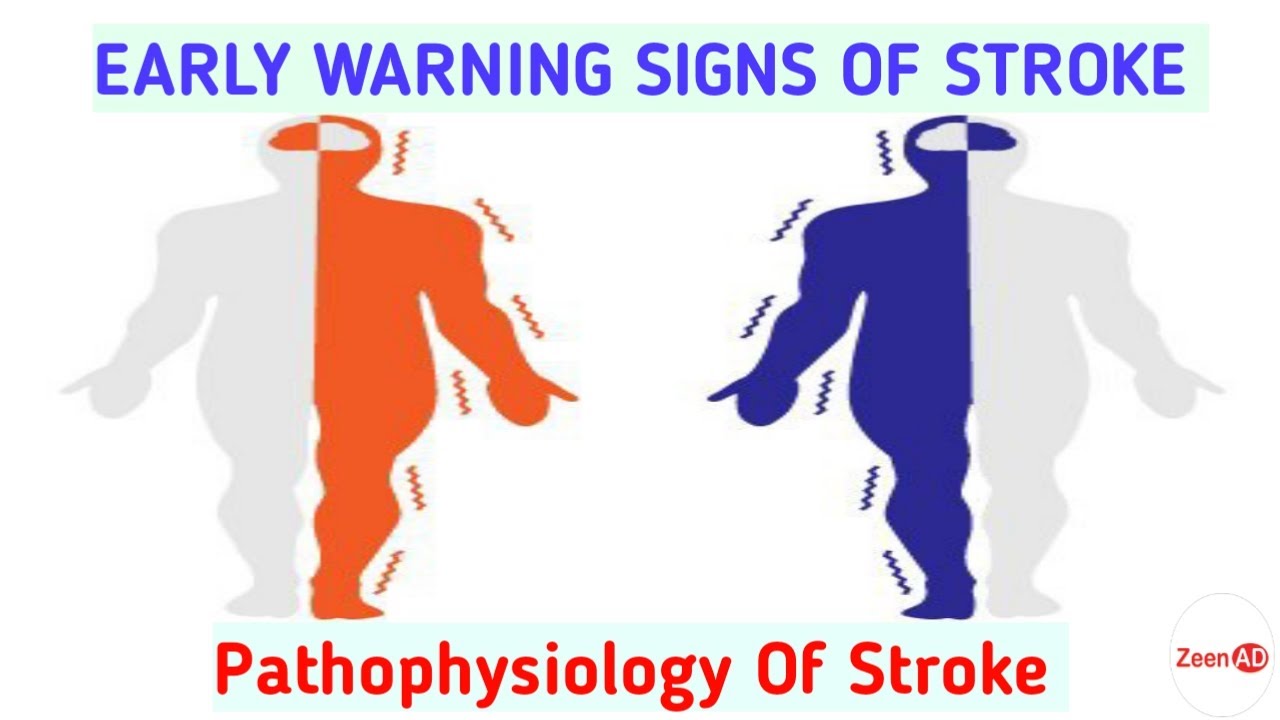 Stroke||EARLY WARNING SIGNS OF STROKE||Pathophysiology Of Stroke ...