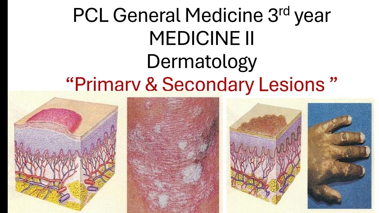 Primary and secondary lesions|| PCL general medicine CTEVT||Medicine II ...