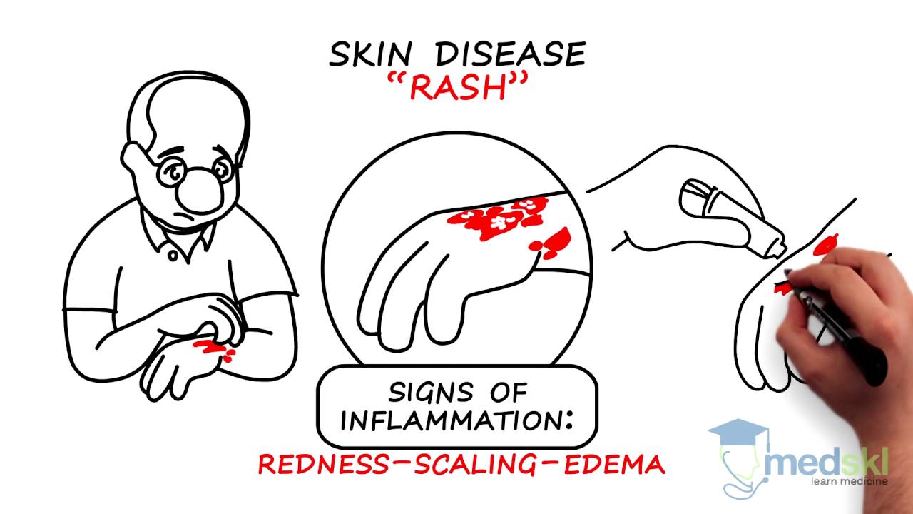 Dermatology - Pruritus: By Aaron Drucker M.D. - YouTube