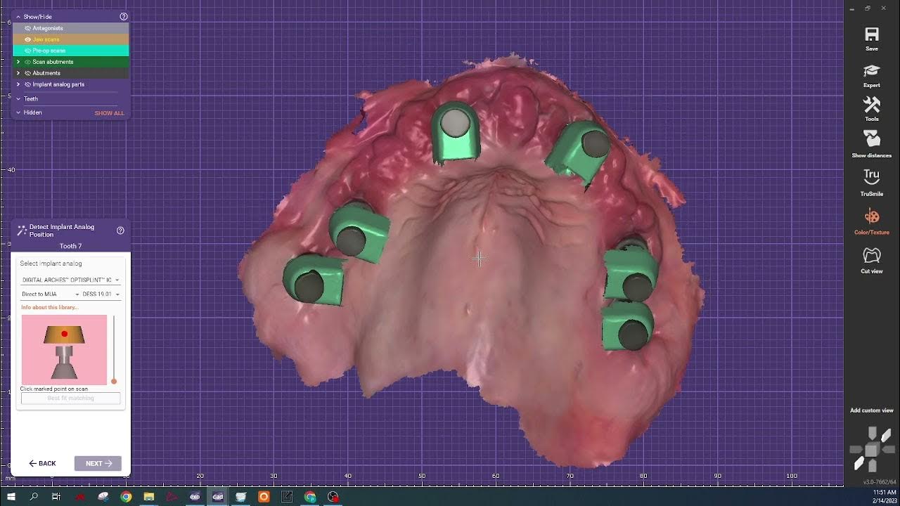 Optisplint (Grammetry) Exocad Full Arch Design - Scan Body Alignment - YouTube