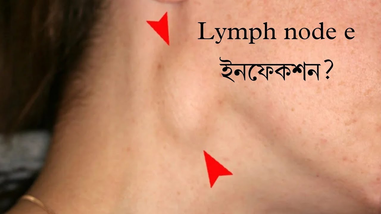 Lymph node e ইনফেকশন/Lymphadenitis/Dr.Joydeb Singha|Lymph node swelling ...