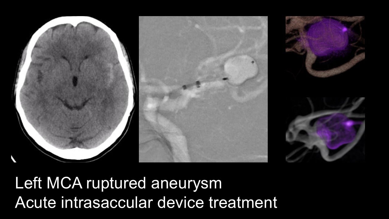 Aneurysm MCA - Acute WEB - YouTube
