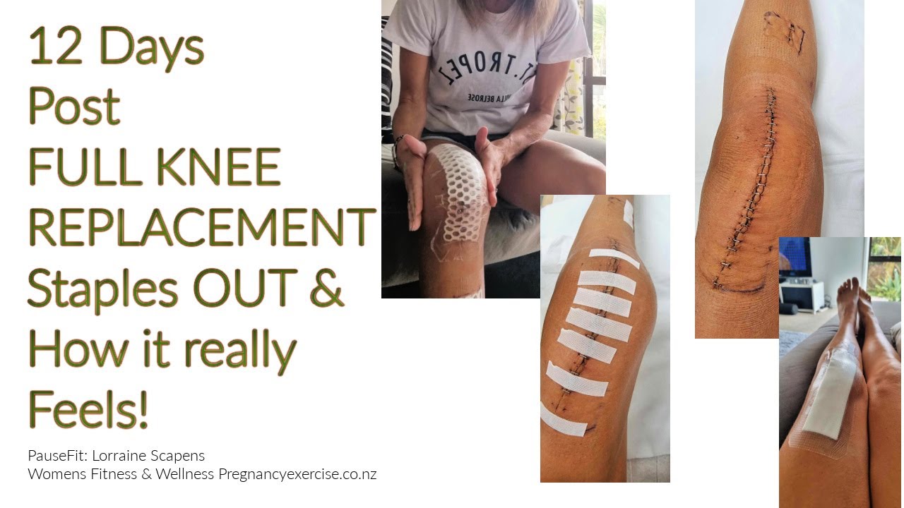 12 Days Post Total Knee Replacement, Staple Removal, and Movement ...