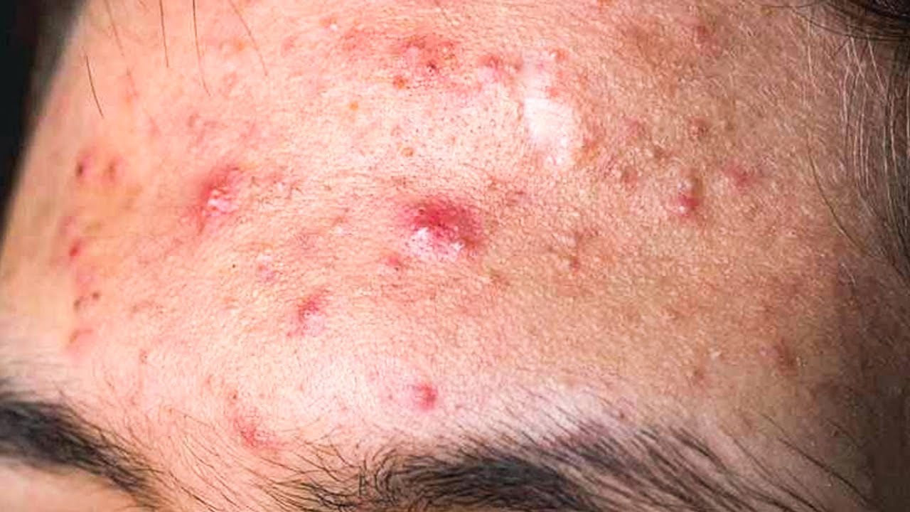 Satisfying and Relaxing Piimple Popping video #011 - YouTube