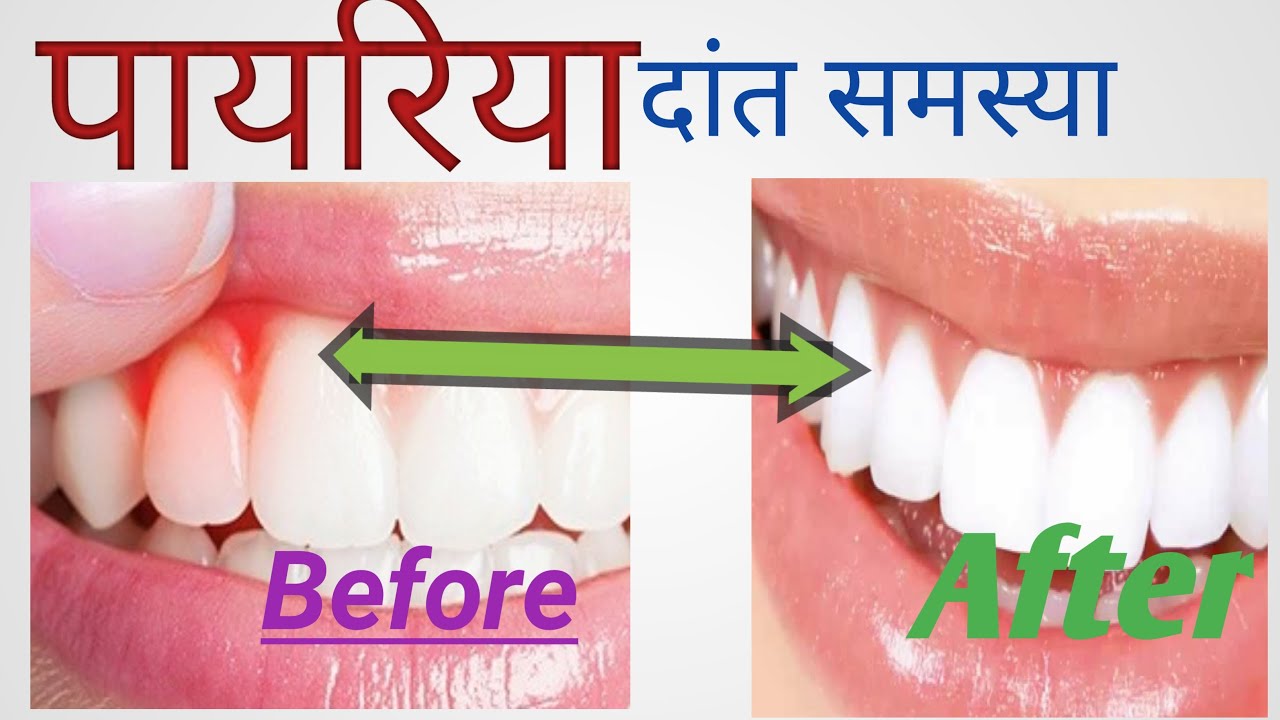 Payriya ka ilaj, tritment for payriya, tooth disease payriya ,पायरिया ...