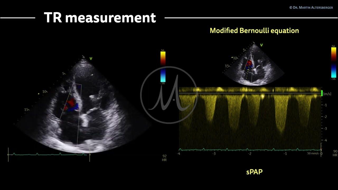 〖echocardiography〗 Tricuspid Regurgitation And Spap Youtube