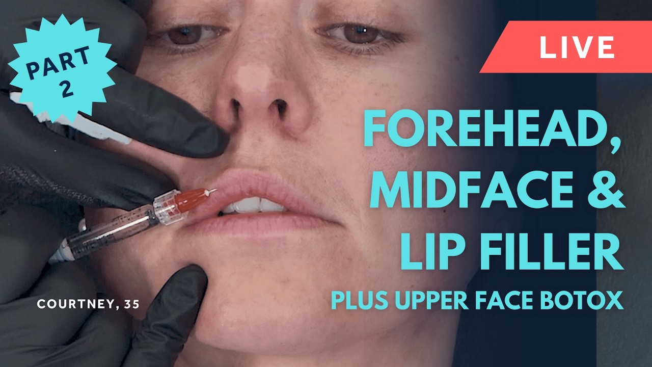 Live Forehead Filler, Lip Filler & Midface Filler Treatments Using ...