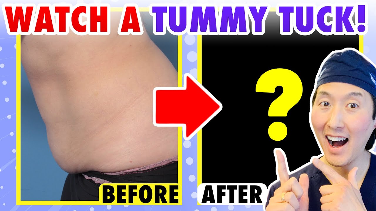 How One Woman Got Rid of Her Extra Tummy Skin! - Dr. Anthony Youn - YouTube