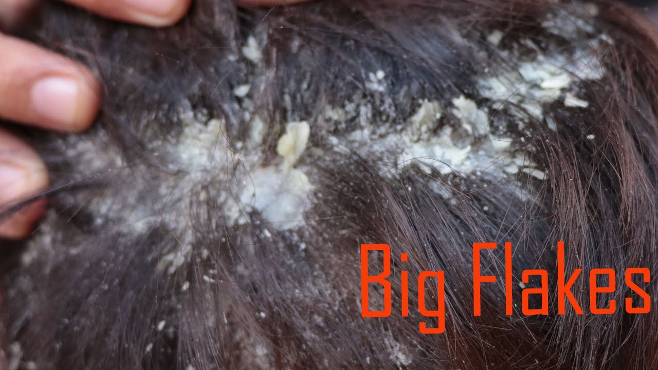 Dandruff combing #8 BIG FLAKES Dandruff Removal with Comb Satisfying ...