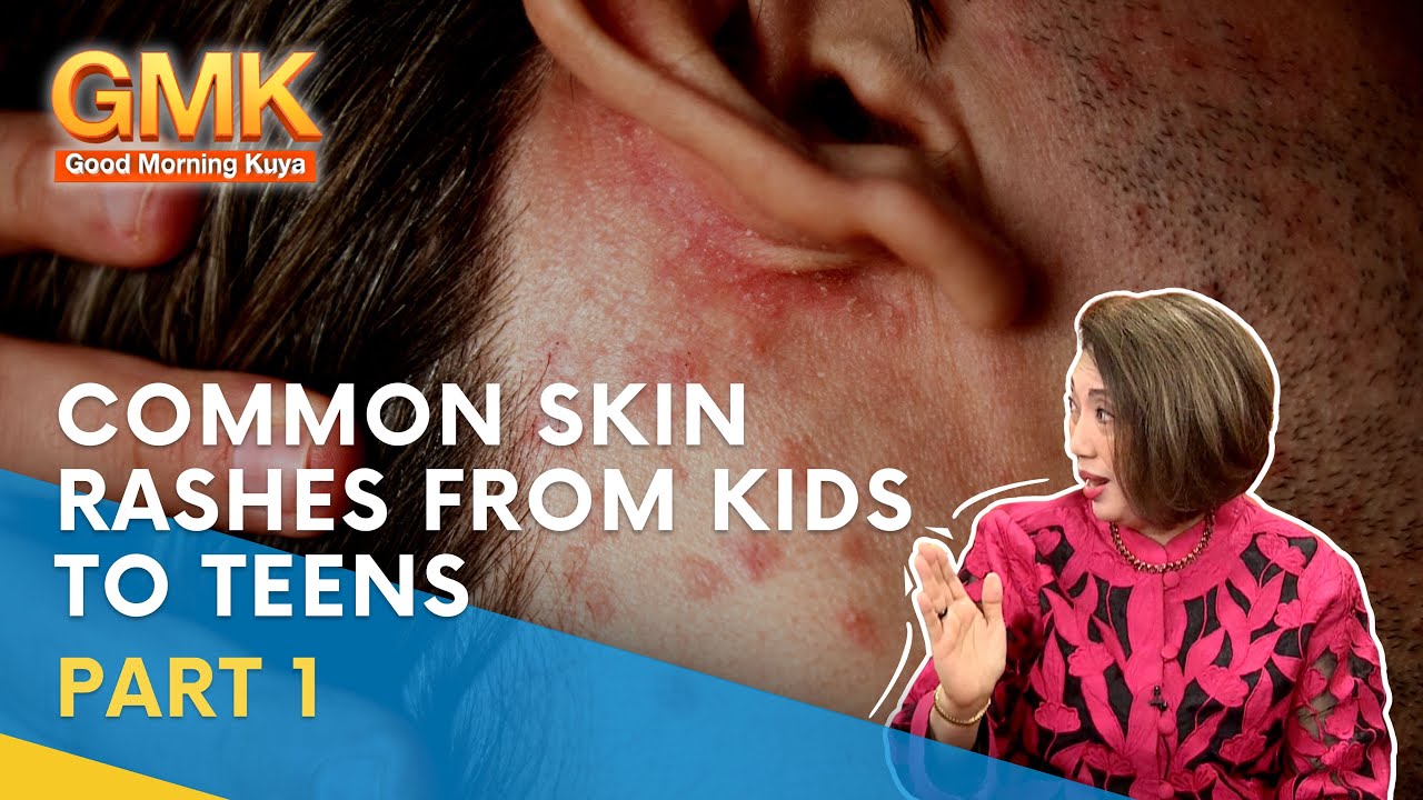 Common Skin Rashes from Kids to Teens (Part 1) | Usapang Pangkalusugan ...
