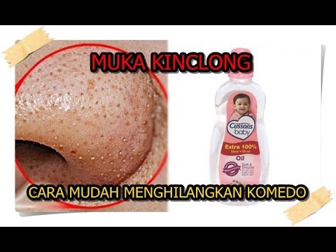 CARA MUDAH MENGHILANGKAN KOMEDO | MUKA KINCLONG - YouTube