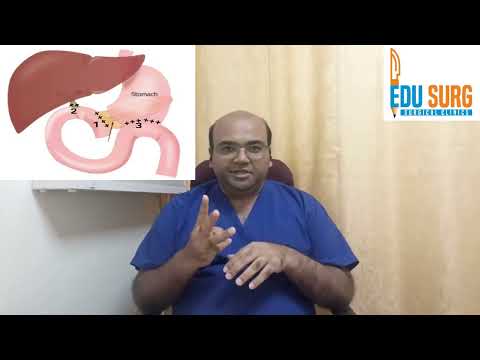 What is the Whipple procedure? - Surgical procedure you NEED to know if ...