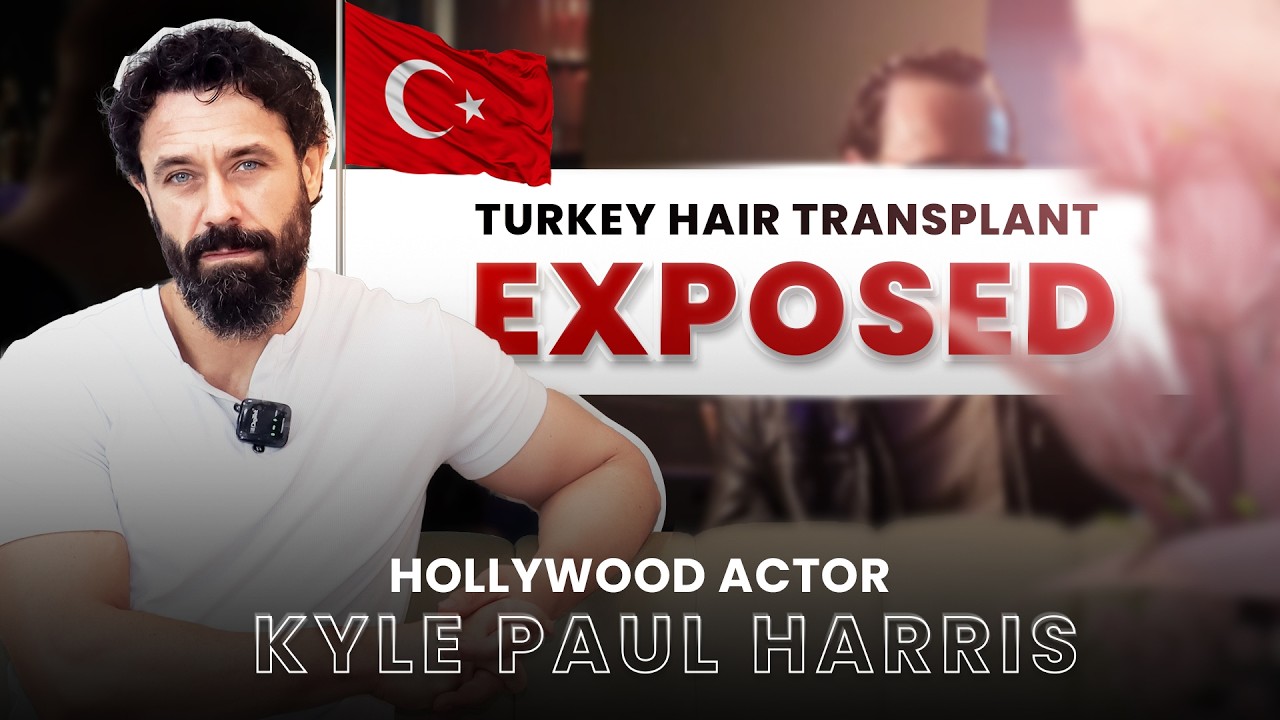 Dark reality of turkey hair transplant exposed by Hollywood actor@kyle ...