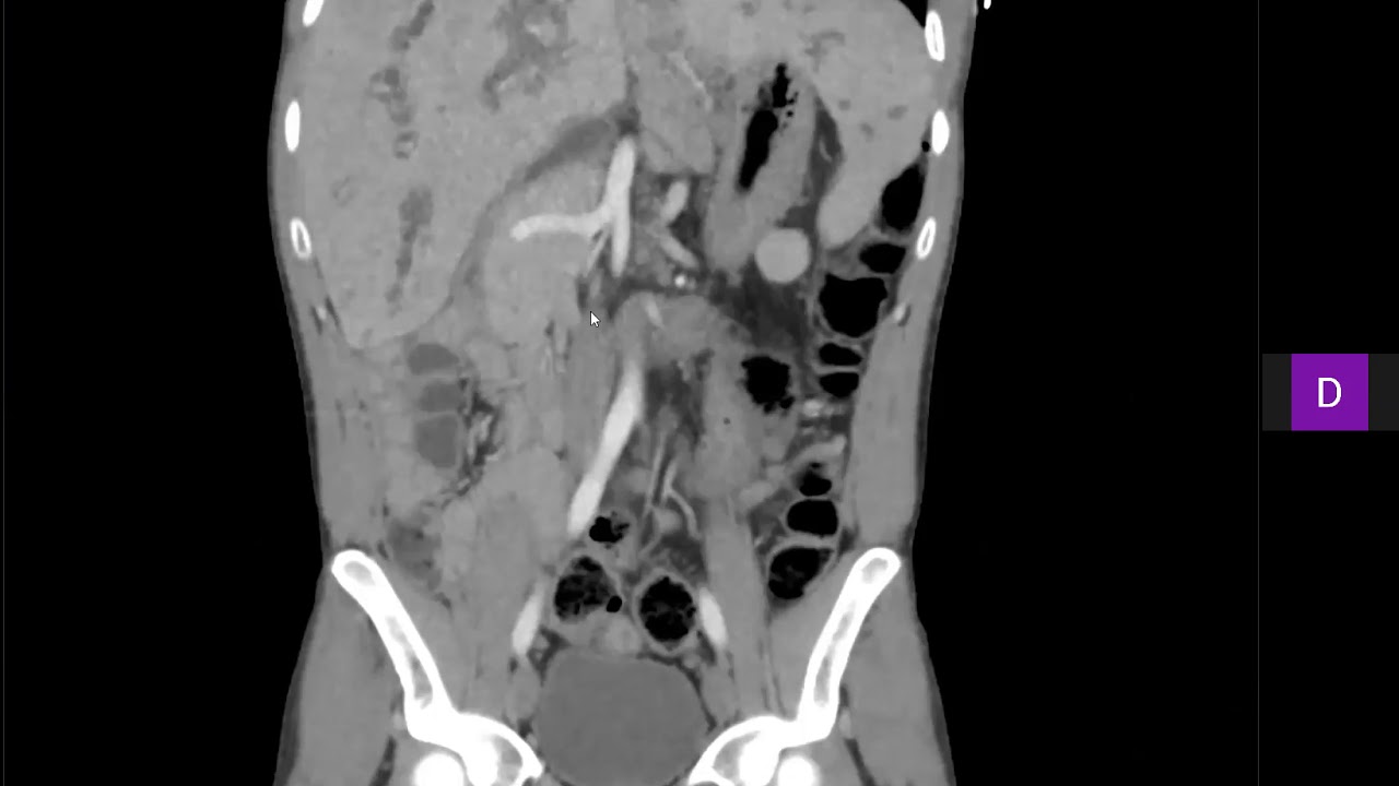 Peribiliary cyst mimic in patient with heterotaxy - Dr Gitanjali Bajaj ...