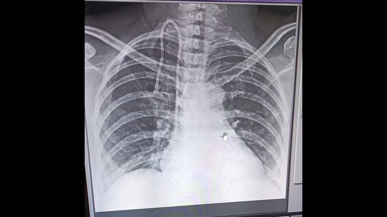 Totally Implantable Venous Access Device - Chemo Port - YouTube