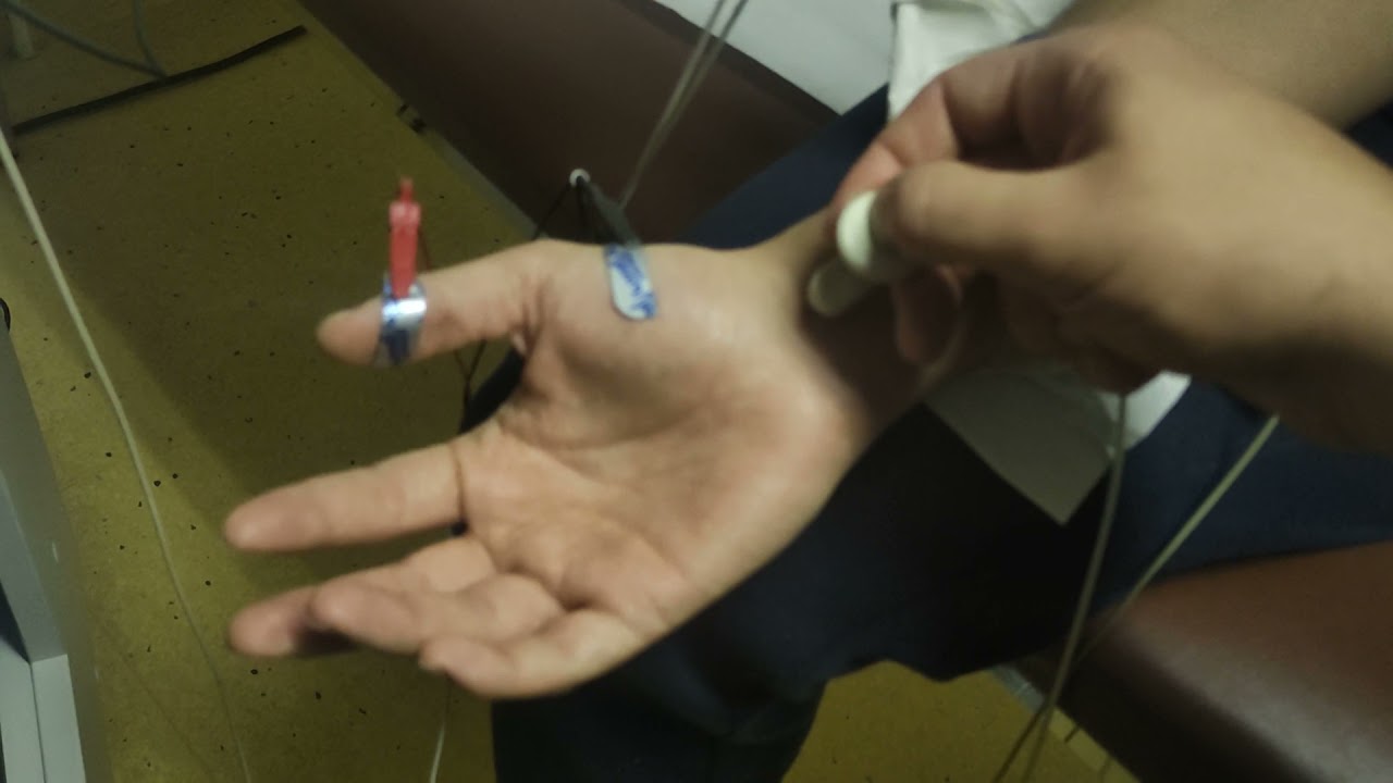 Motorische ENG N. medianus (Elektroneurographie) - YouTube