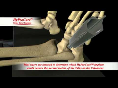 HyProCure® Animation Short - Learn about HyProCure® - YouTube