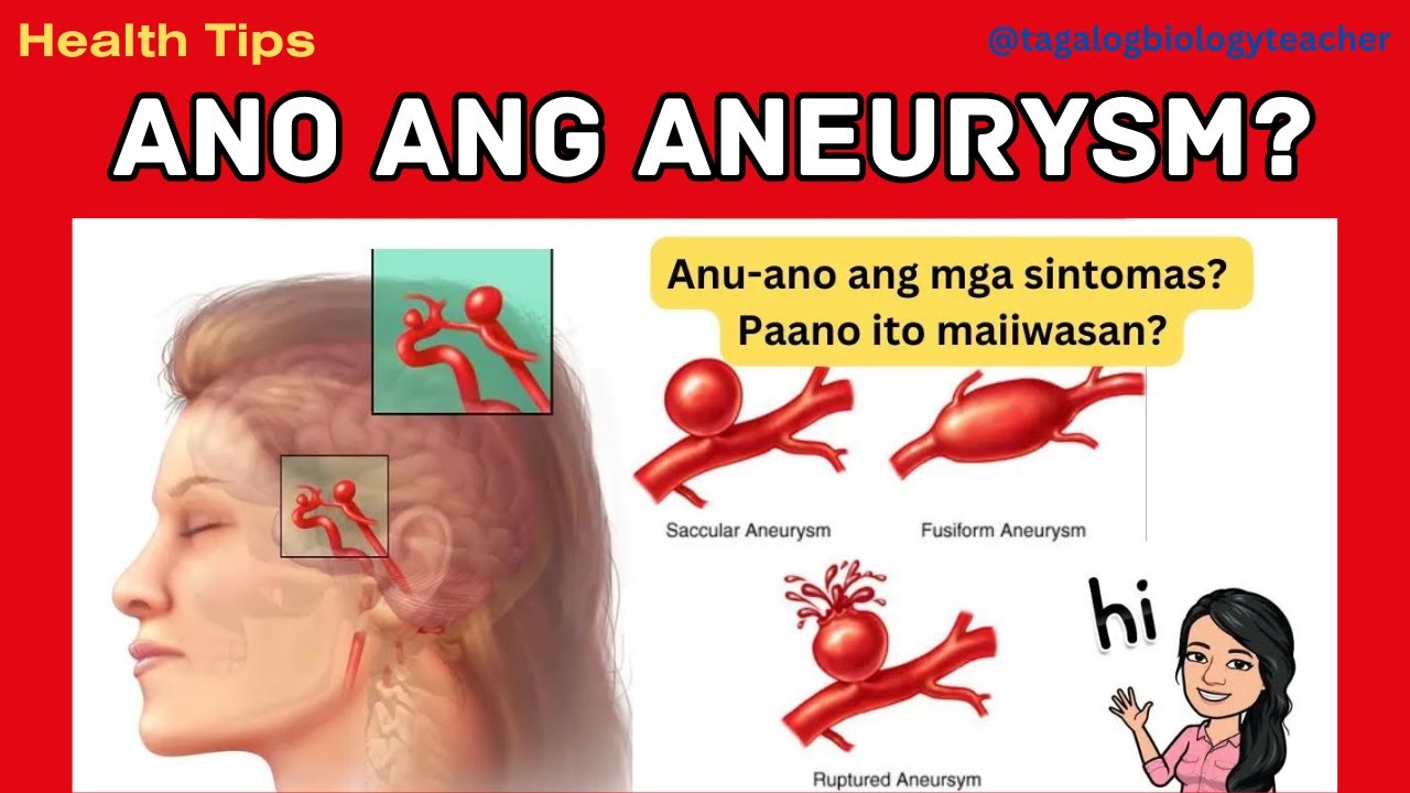 Ano ang Aneurysm | Signs and Symptoms | Health Tips #1 Tagalog - YouTube
