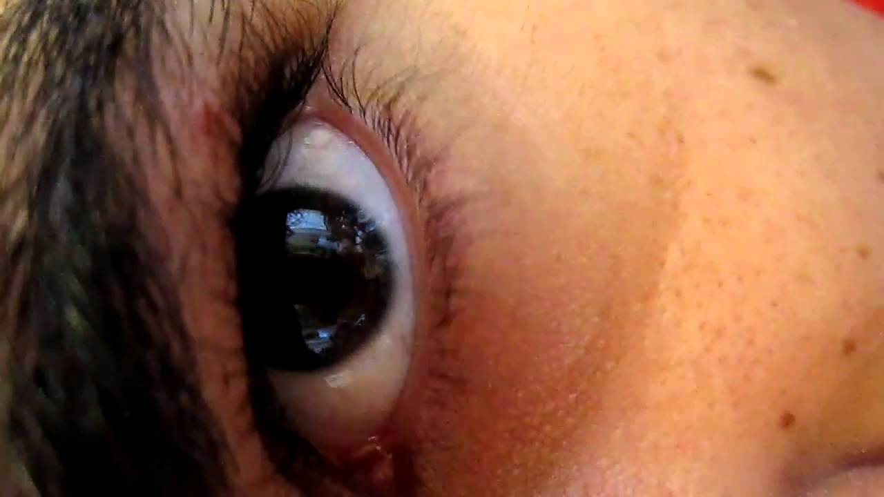 FREAKY EYE DEFORMITY!!! - YouTube