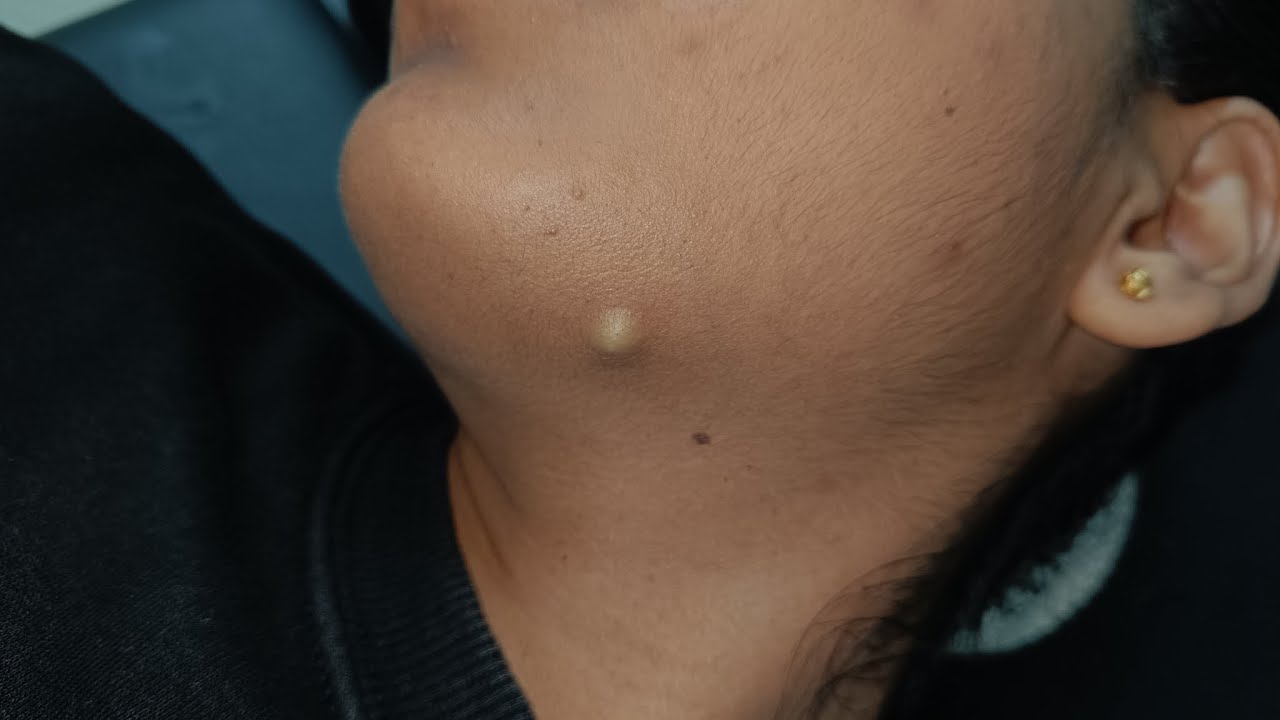 Dermoid cyst over face excision - YouTube