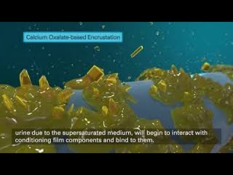 Tria Ureteral Stents – Calcium Oxalate - YouTube