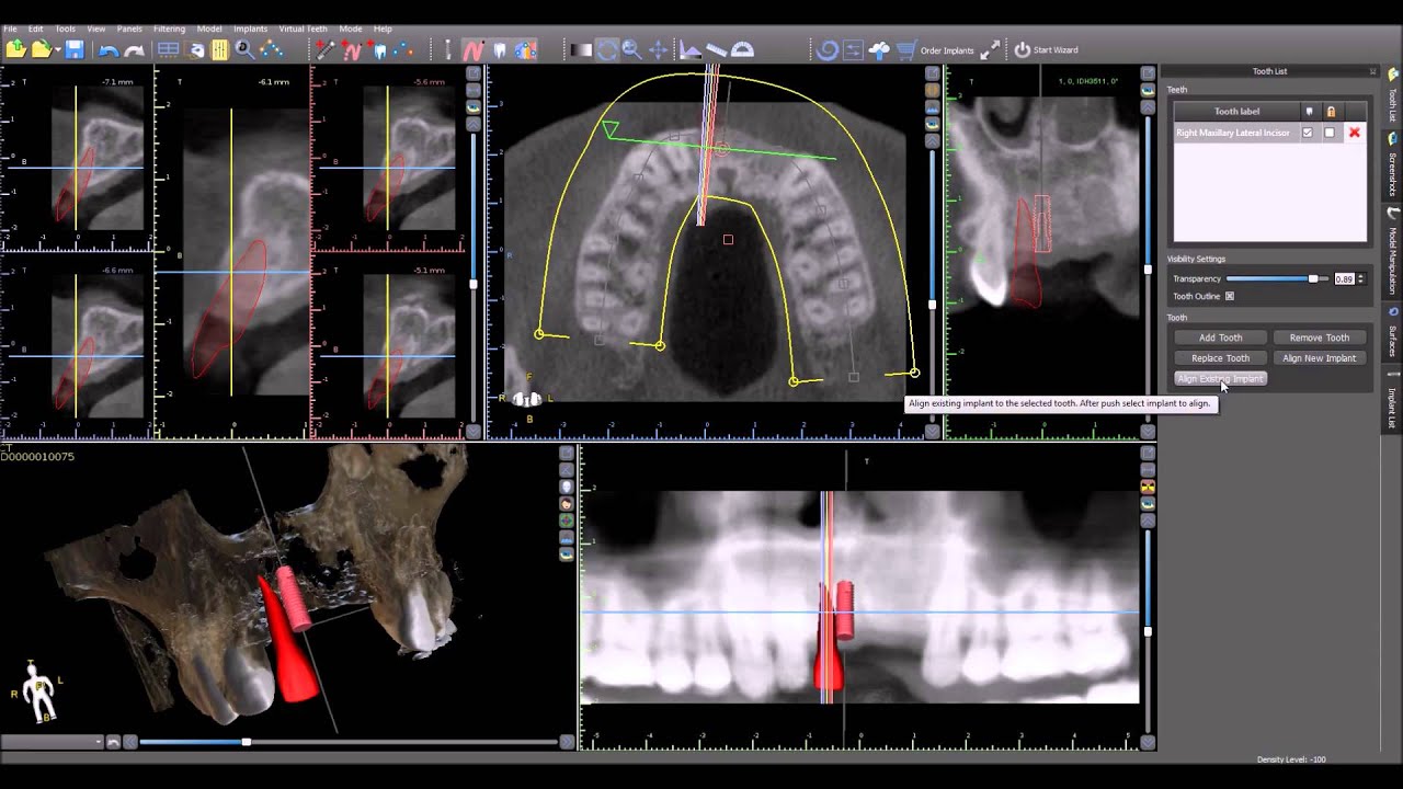 Treatment Planning with Virtual Teeth - YouTube
