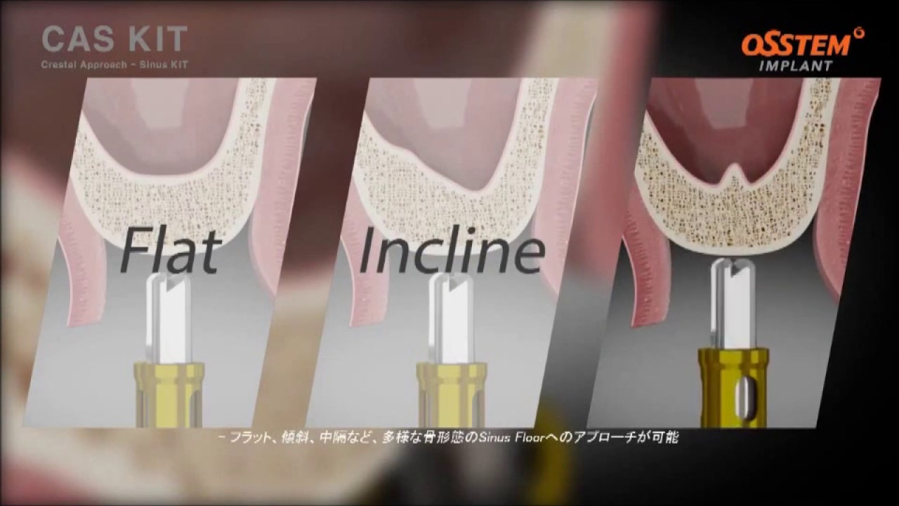 osstem new cas kit - YouTube