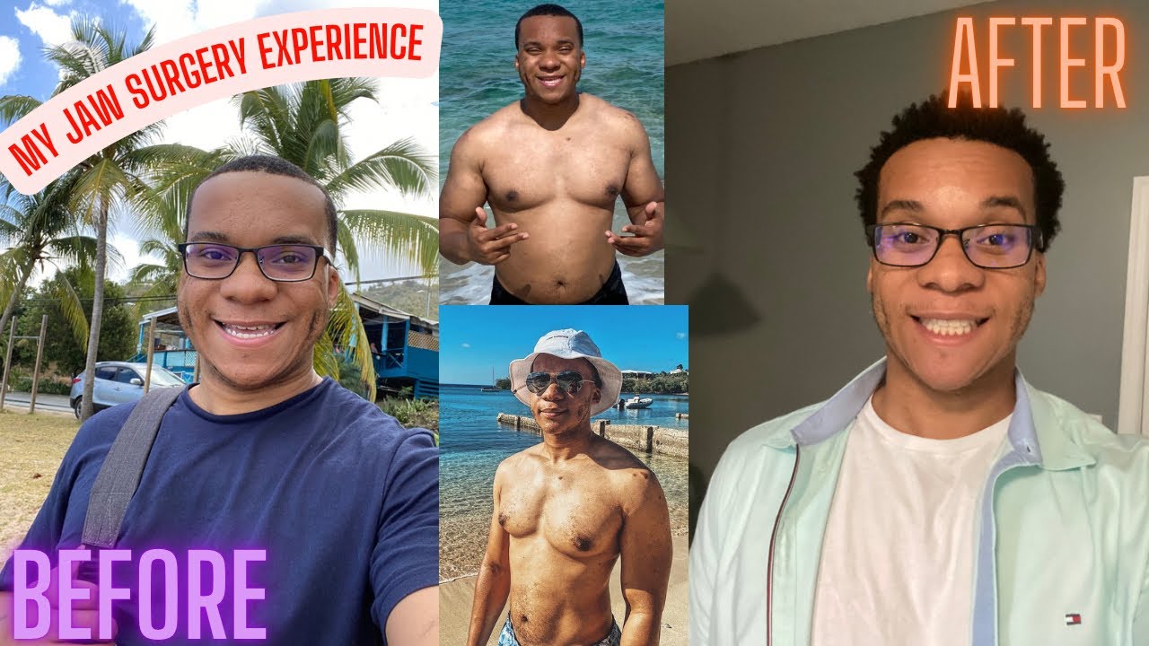 UNDERBITE JAW SURGERY | Experience & Recovery - YouTube