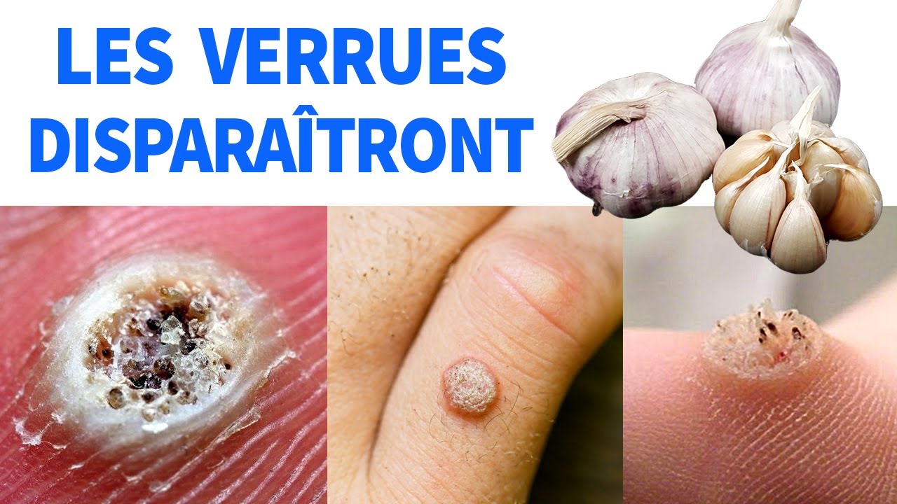 Voici 3 Façons D'enlever Les Verrues Sur La Peau Naturellement - YouTube