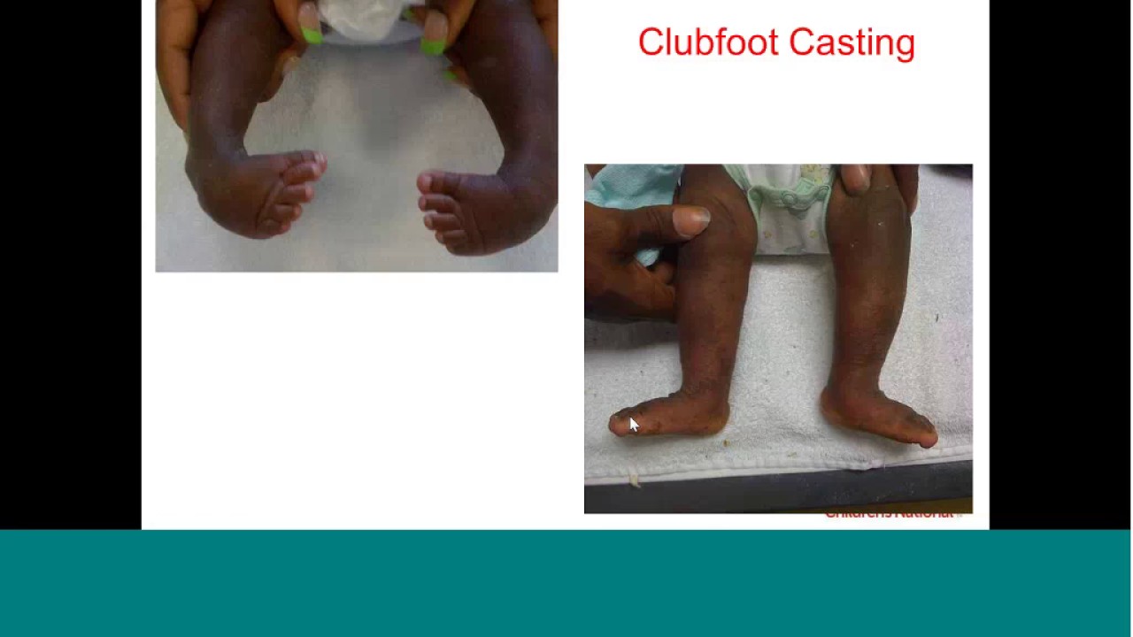 Topics in Fetal Medicine - Congenital Lower Extremity Anomalies - YouTube