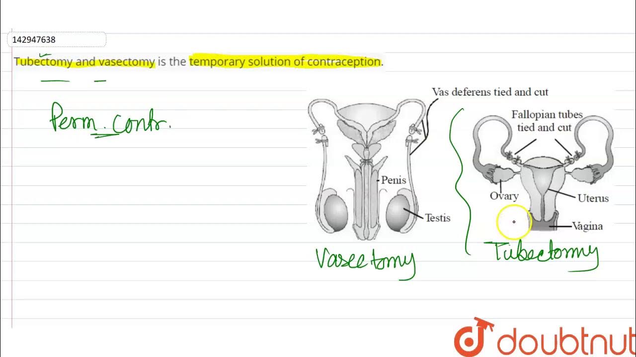 Tubectomy And Vasectomy Is The Temporary Solution Of Contraception