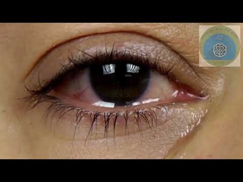 ICD-11 Prolonged Grief Disorder 6B42 @drayubkarim292 - YouTube