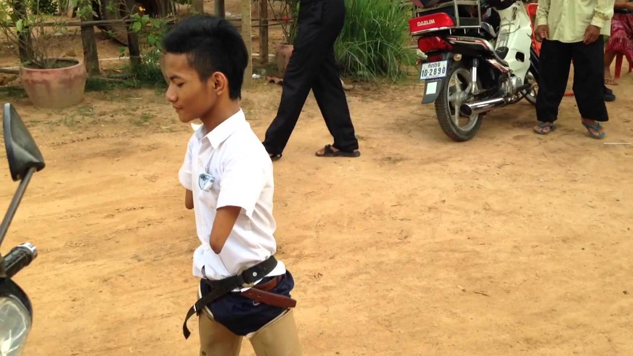 Limbless boy can walk - YouTube