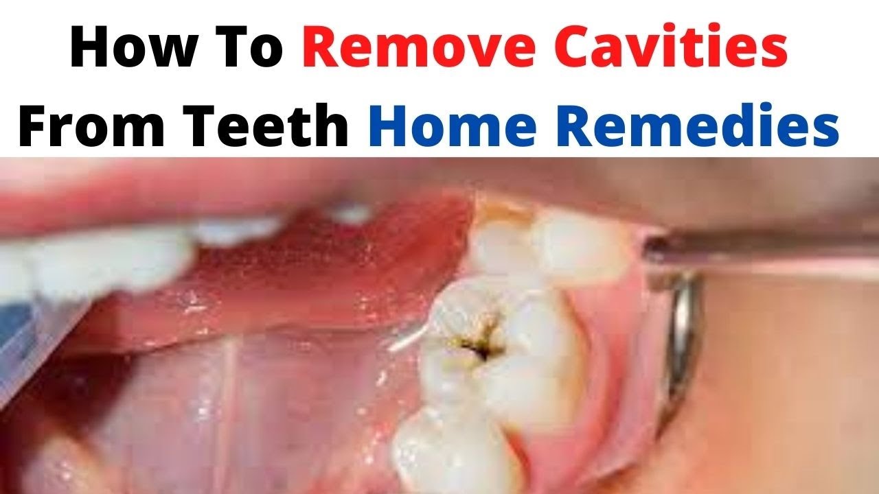 Cavities Removal Home Remedies - How To Remove Cavities From Teeth Home ...