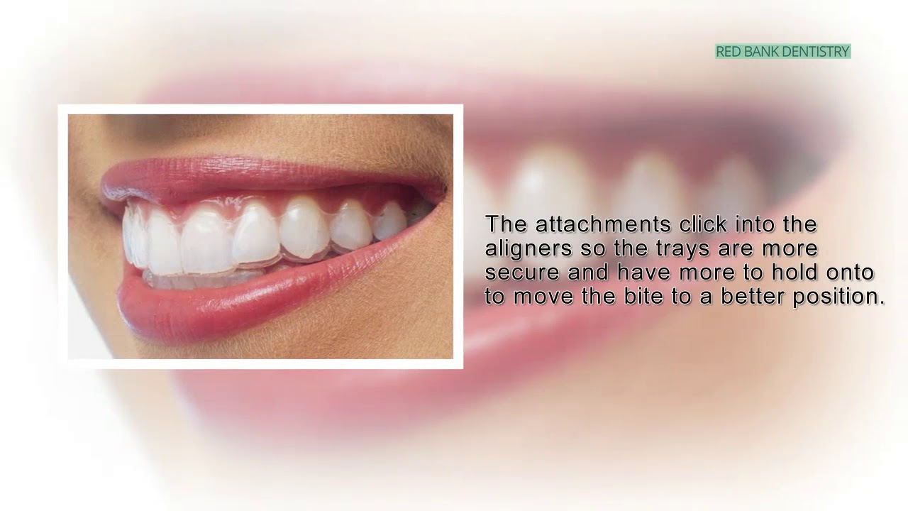 Understanding Invisalign Attachments in Red Bank NJ | RedBankDentistry ...