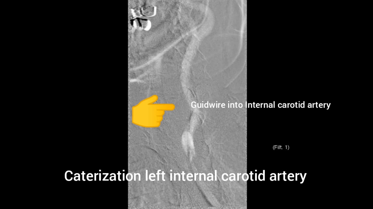 Caterization of left internal carotid artery - YouTube