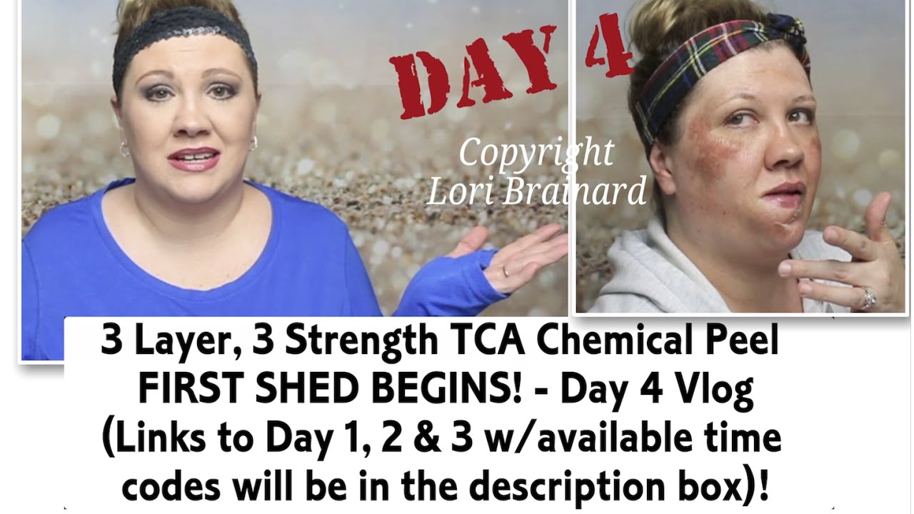 TCA DIY Melasma Peel At Home | 3 Strength, 3 Layer | Day 4 | First Shed ...
