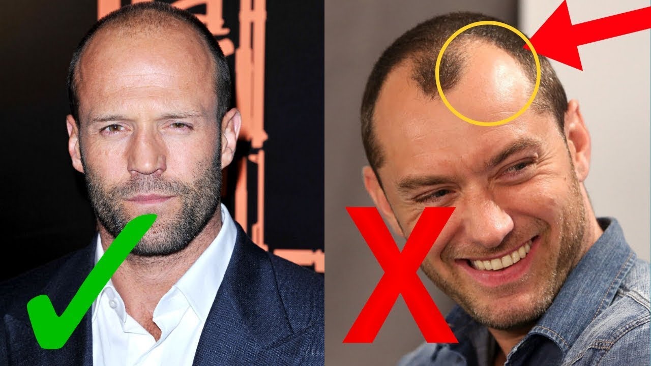 WORST Mistakes You Make When Dealing With Hair Loss - YouTube