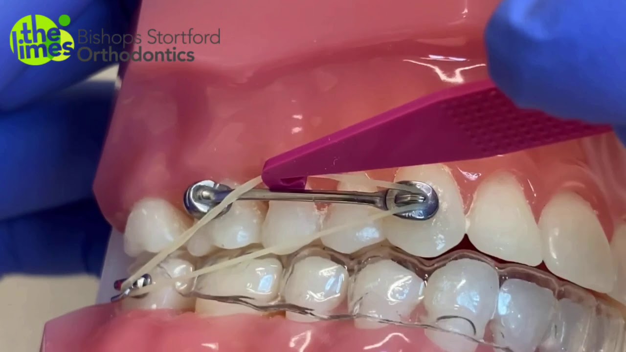 Elastics - Class II Carriere - YouTube