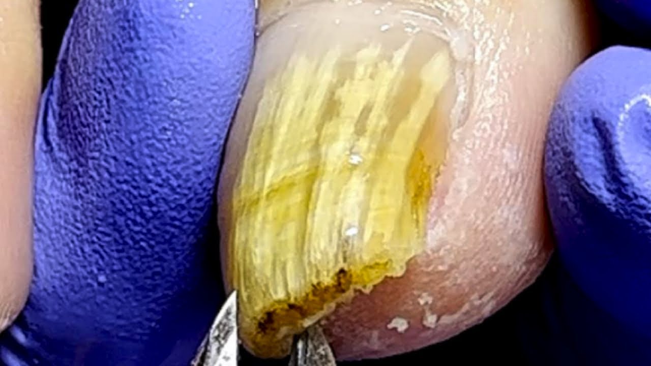 Trimming Gray Nails, The Average Nail Has Become Empty【Pedicure King ...